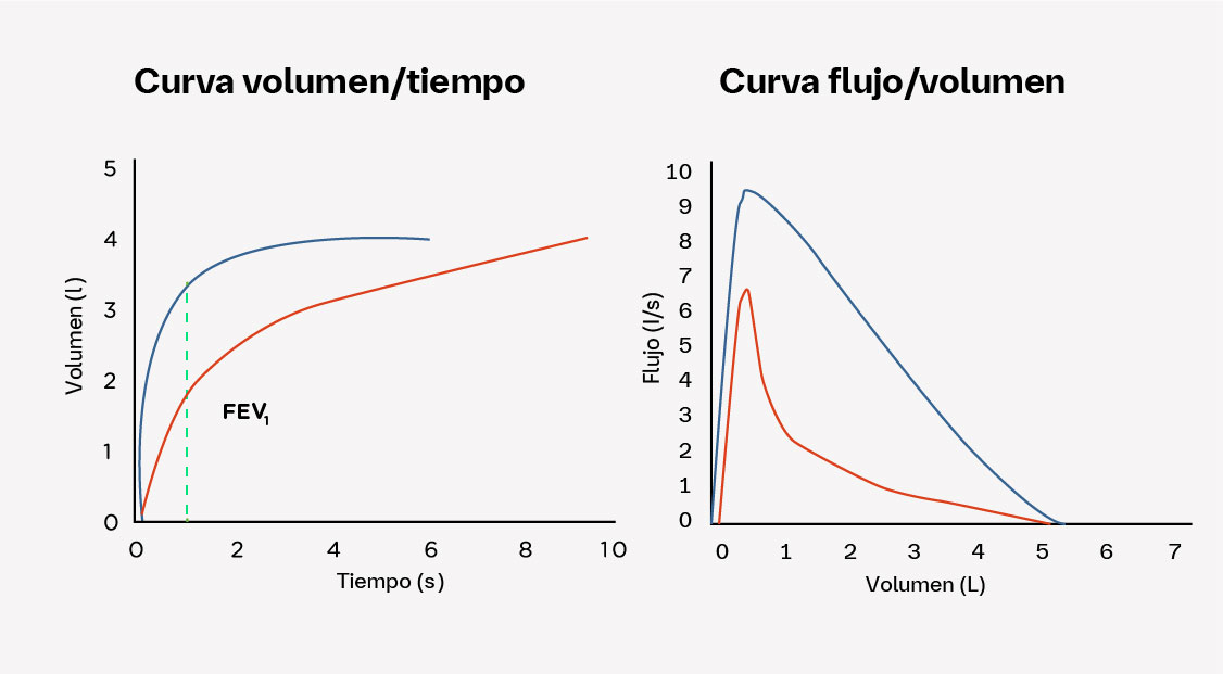 Las claves para interpretar correctamente una espirometría | Avances en ...