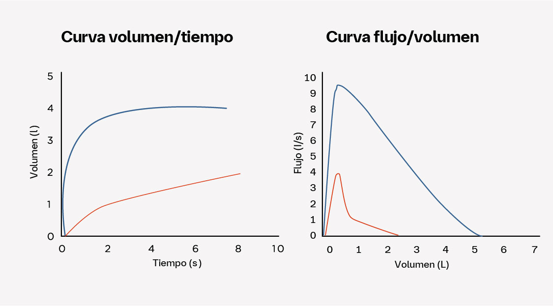 Las claves para interpretar correctamente una espirometría | Avances en ...