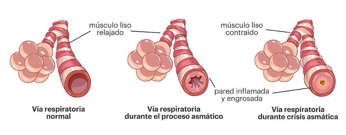 Avances en Respiratorio | Sintomatología del asma. Médicos