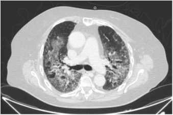 Las exacerbaciones en pacientes con FPI | Notícias | Avances en ...
